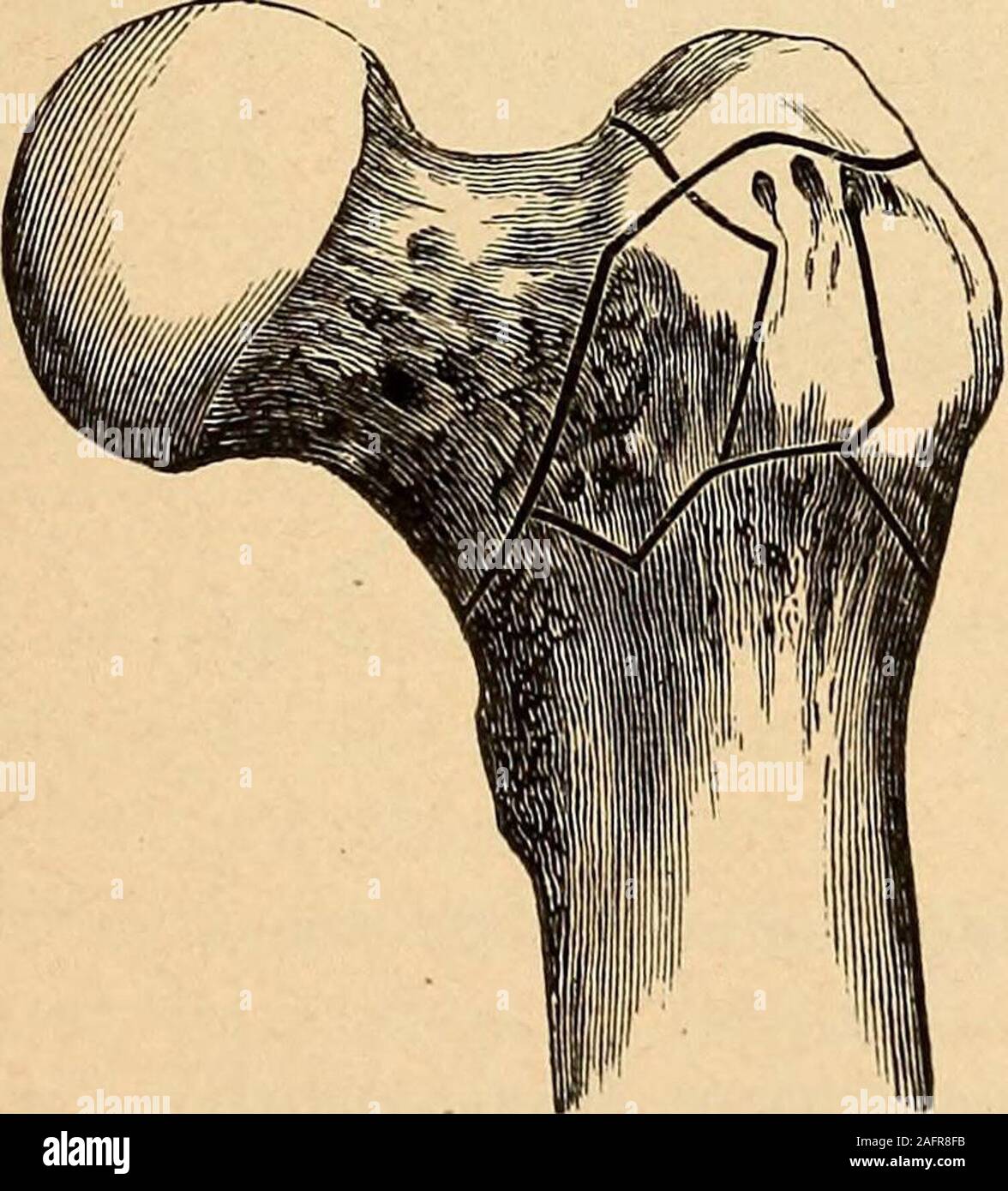 Lesser trochanter hi-res stock photography and images - Alamy