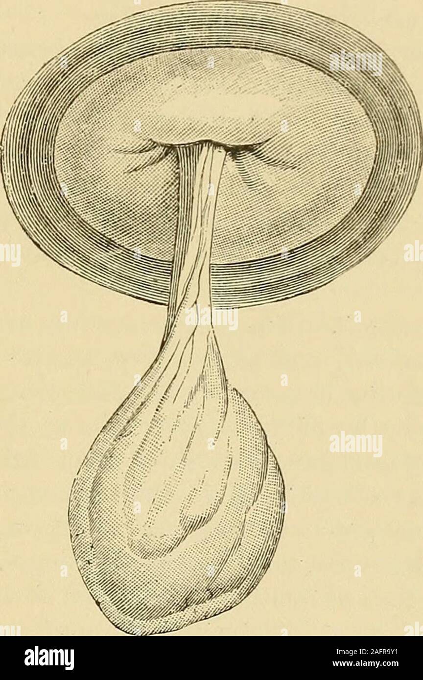 Retained Placenta High Resolution Stock Photography and Images - Alamy