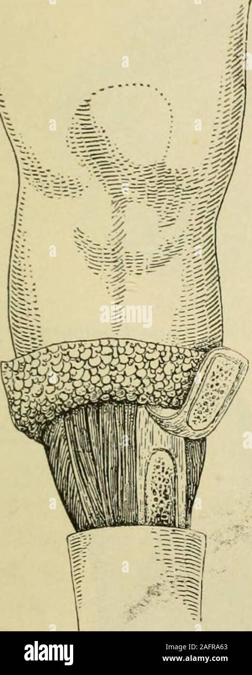 Amputa hi-res stock photography and images - Alamy