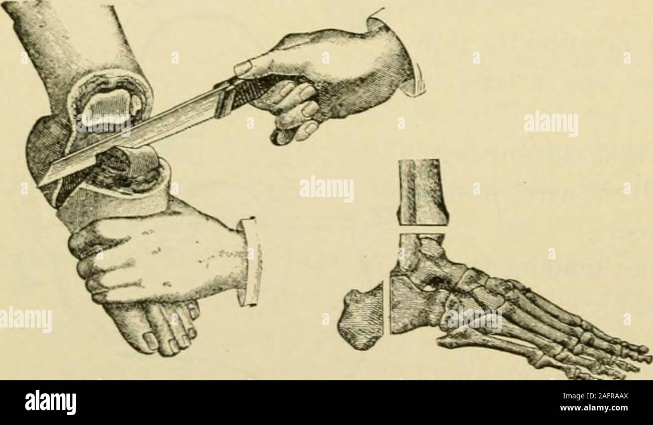 Malleoli hi-res stock photography and images - Alamy