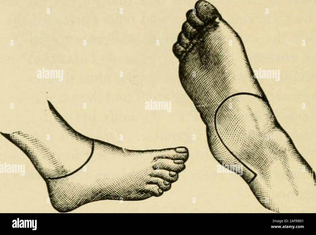 Rouxs amputation hi-res stock photography and images - Alamy