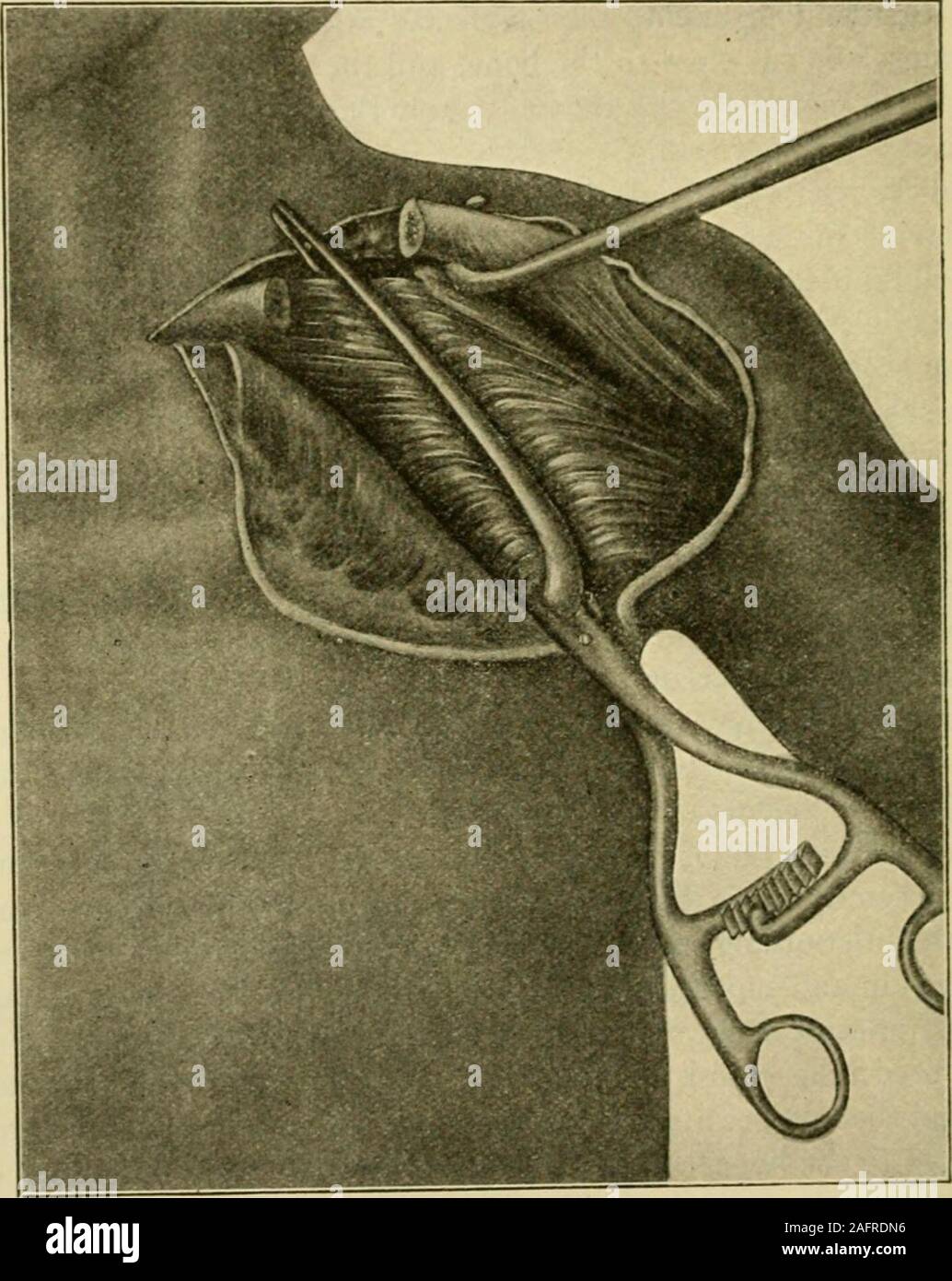 Cervical incision hi-res stock photography and images - Alamy