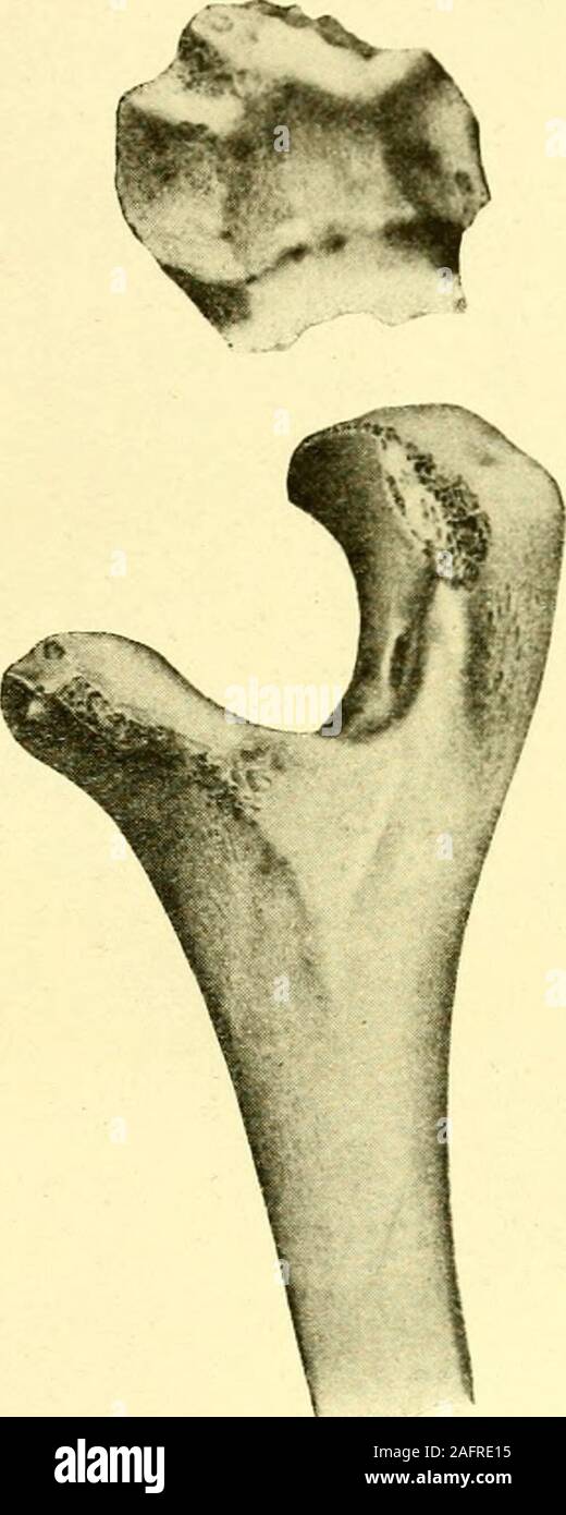Healed fracture' hi-res stock photography and images - Alamy