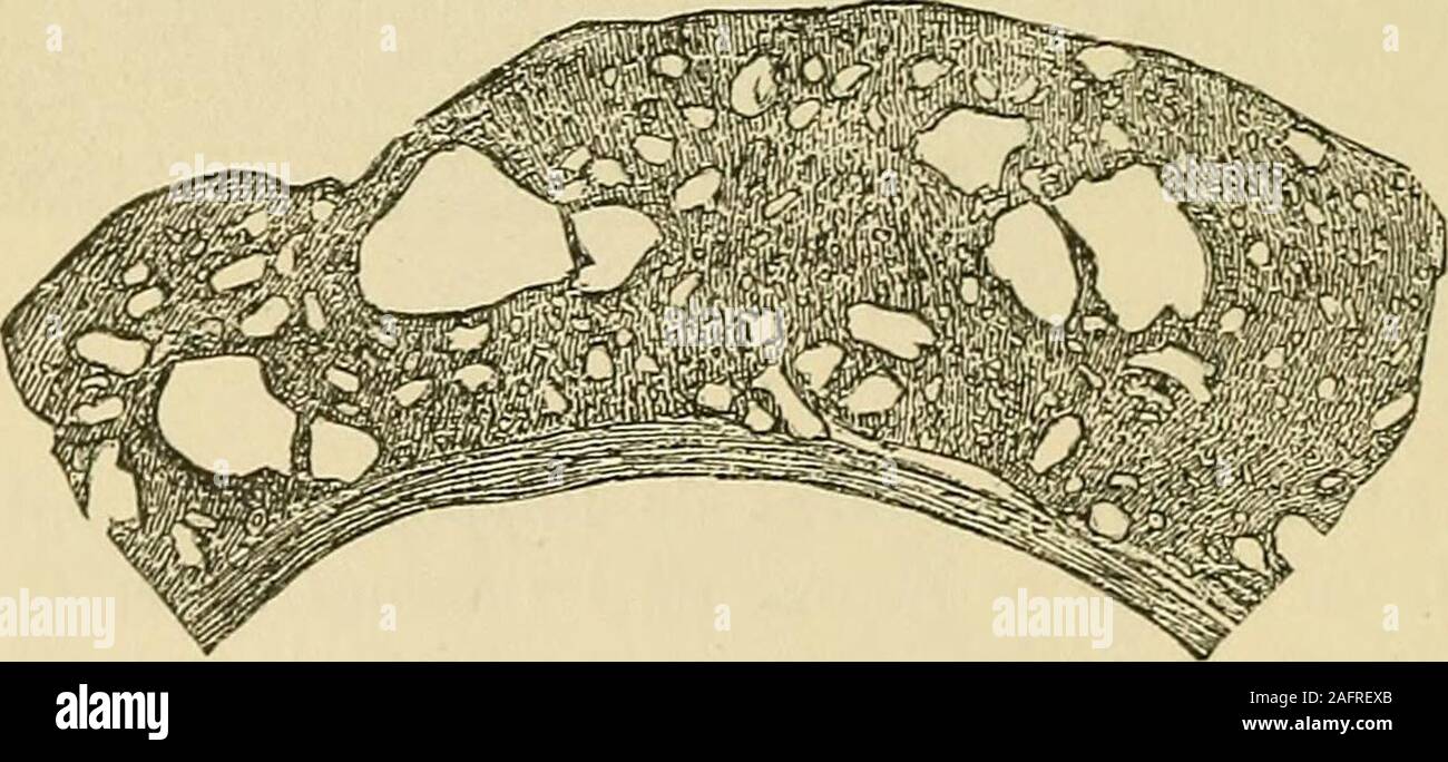 . Cyclopædia of obstetrics and gynecology. Fig. 20.—Atrophy of Mucous ...