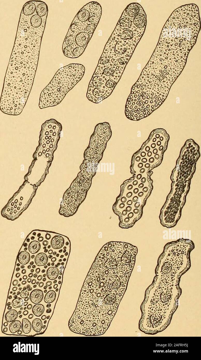 Fatty Casts In Urine