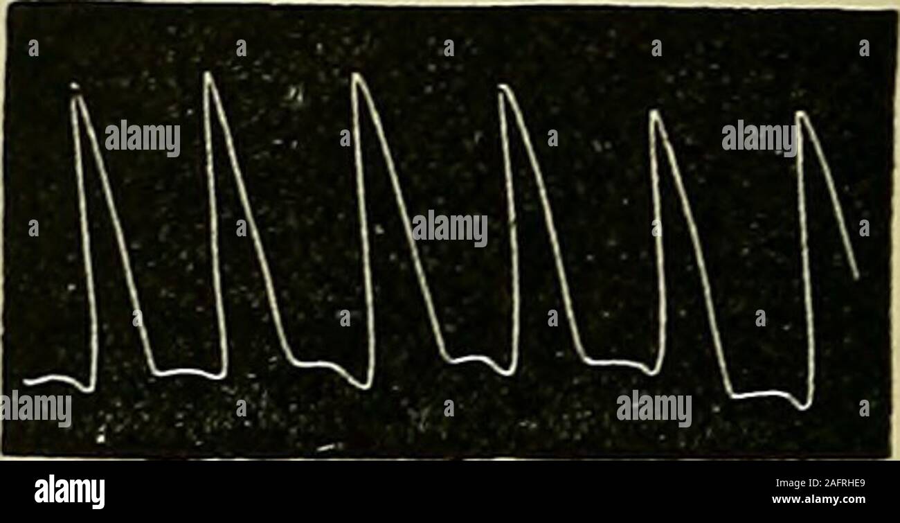Weak pulse hi-res stock photography and images - Alamy
