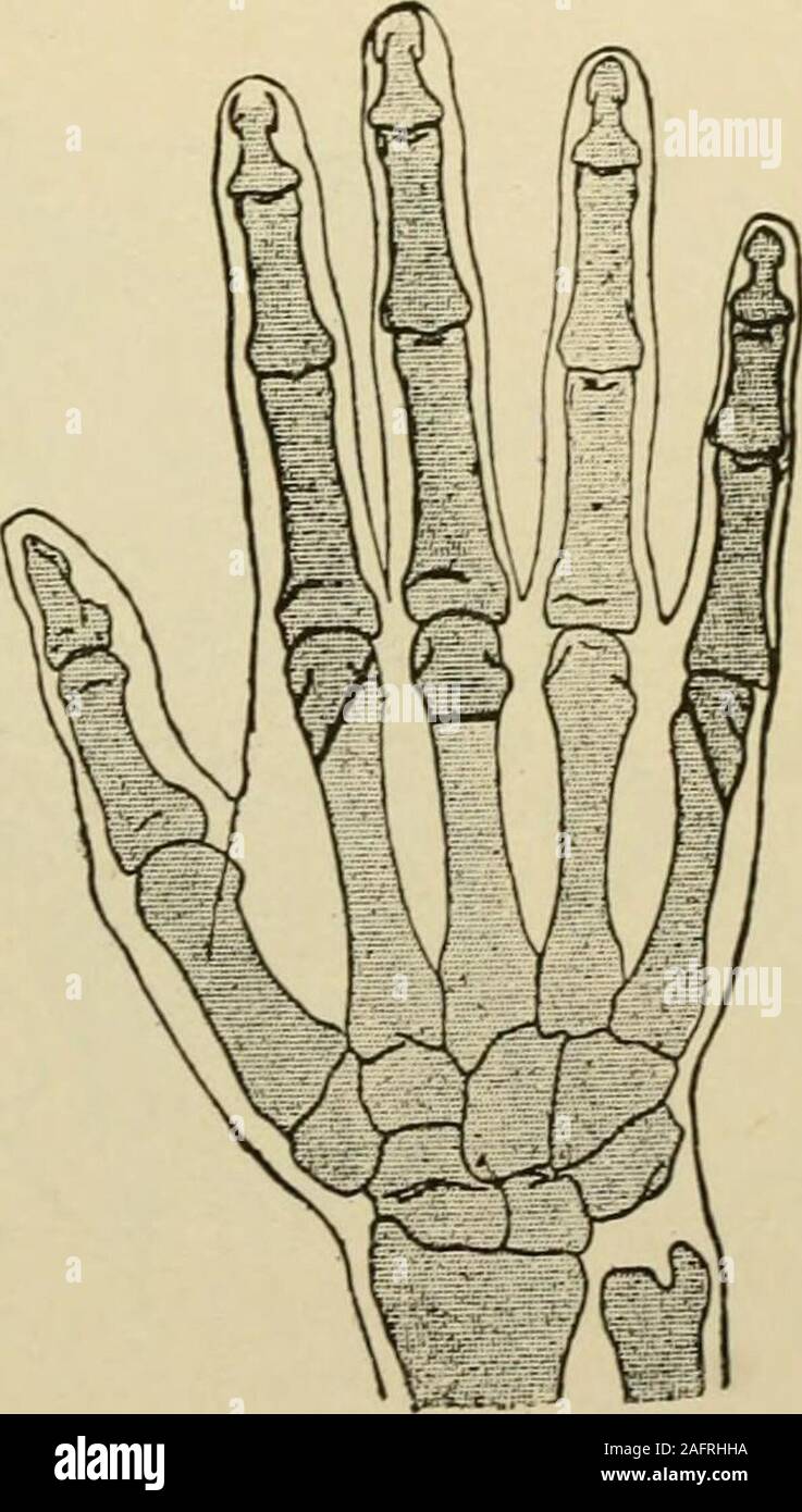 Metacarpal phalangeal hi-res stock photography and images - Alamy