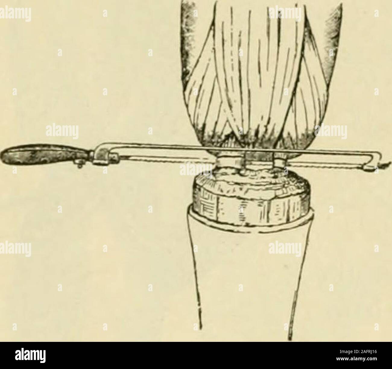 Below knee amputation stump hi-res stock photography and images - Alamy