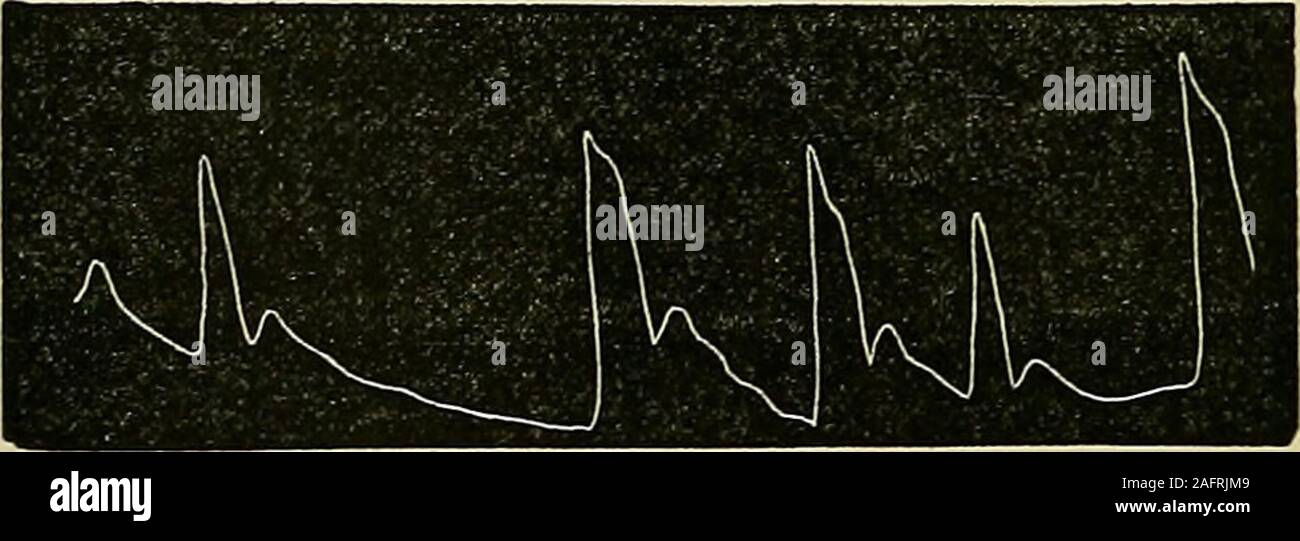 . Diseases of the heart and thoracic aorta. Pressure 4 ozFig. 118 ...