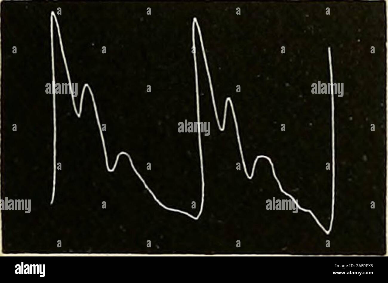 Disease dropsy hi-res stock photography and images - Alamy
