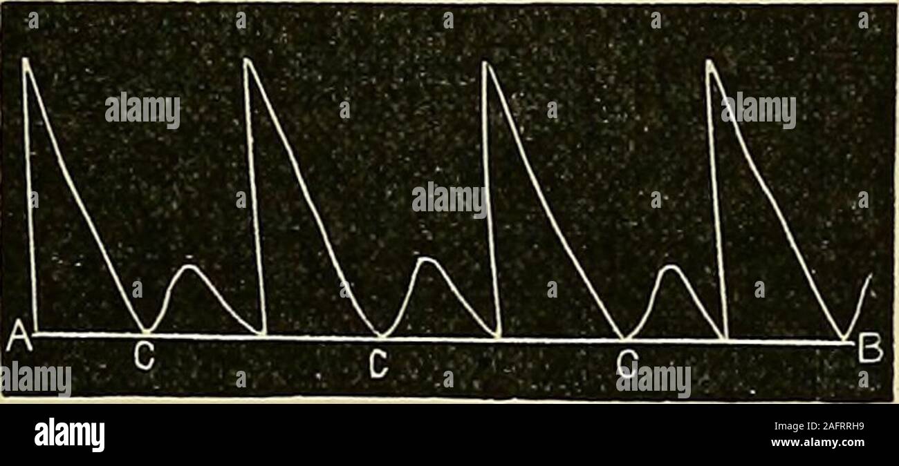 . Diseases of the heart and thoracic aorta. Fig. 90.—Dicrotic Pulse ...