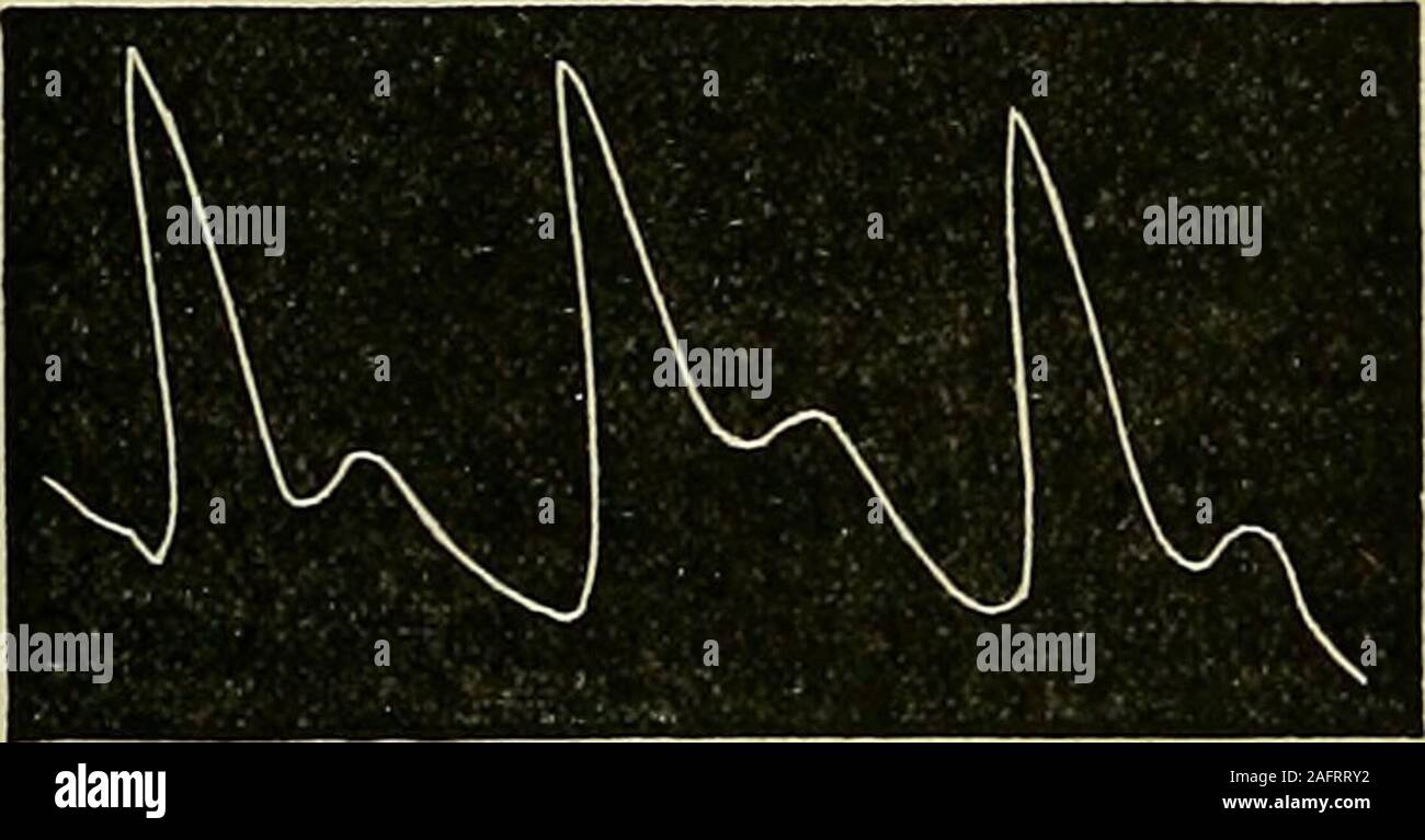 Upper lobe of the right lung hi-res stock photography and images - Alamy