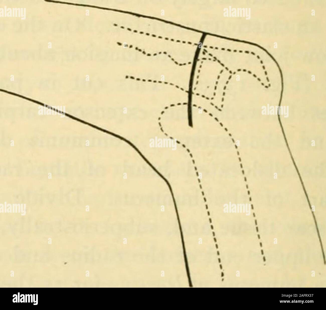 Nerve saw hi-res stock photography and images - Alamy