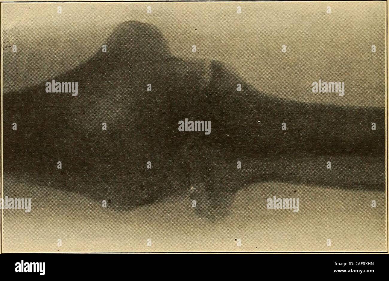 Olecranon Fracture High Resolution Stock Photography and Images - Alamy