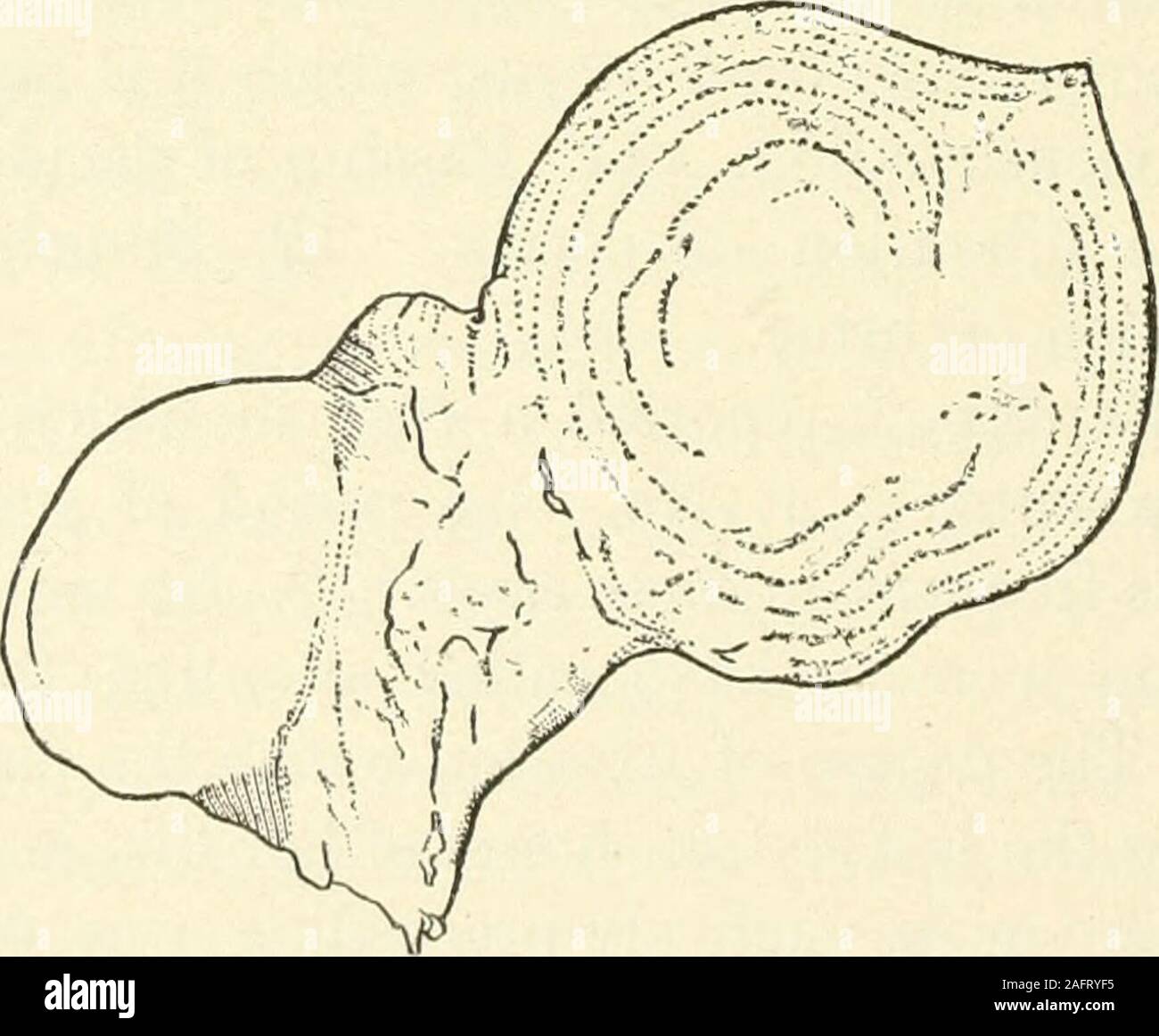. Annual of the universal medical sciences. Fig. 1.—Tubal Peegnancy ...