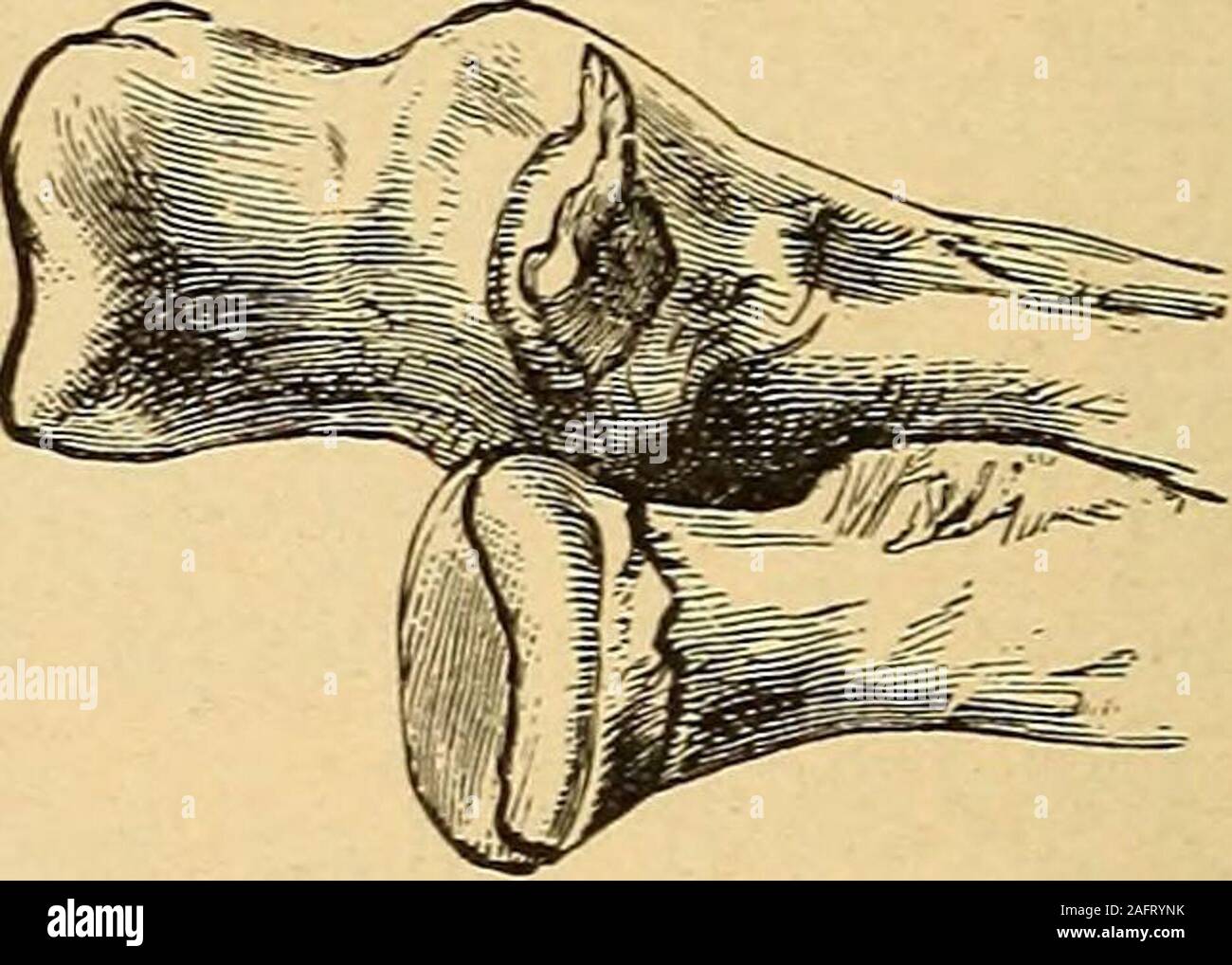 Fracture olecranon process of ulna hi-res stock photography and images ...