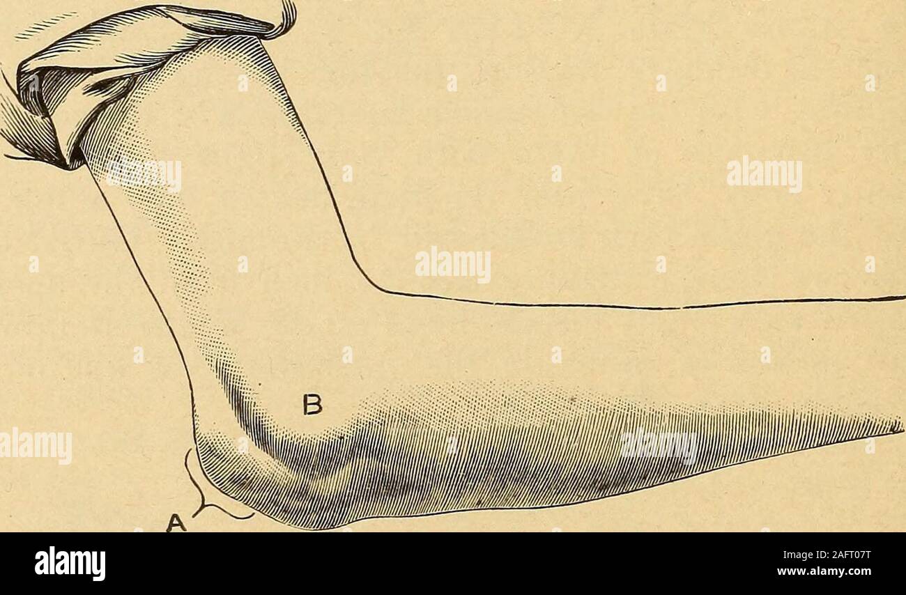 Olecranon fracture hi-res stock photography and images - Alamy