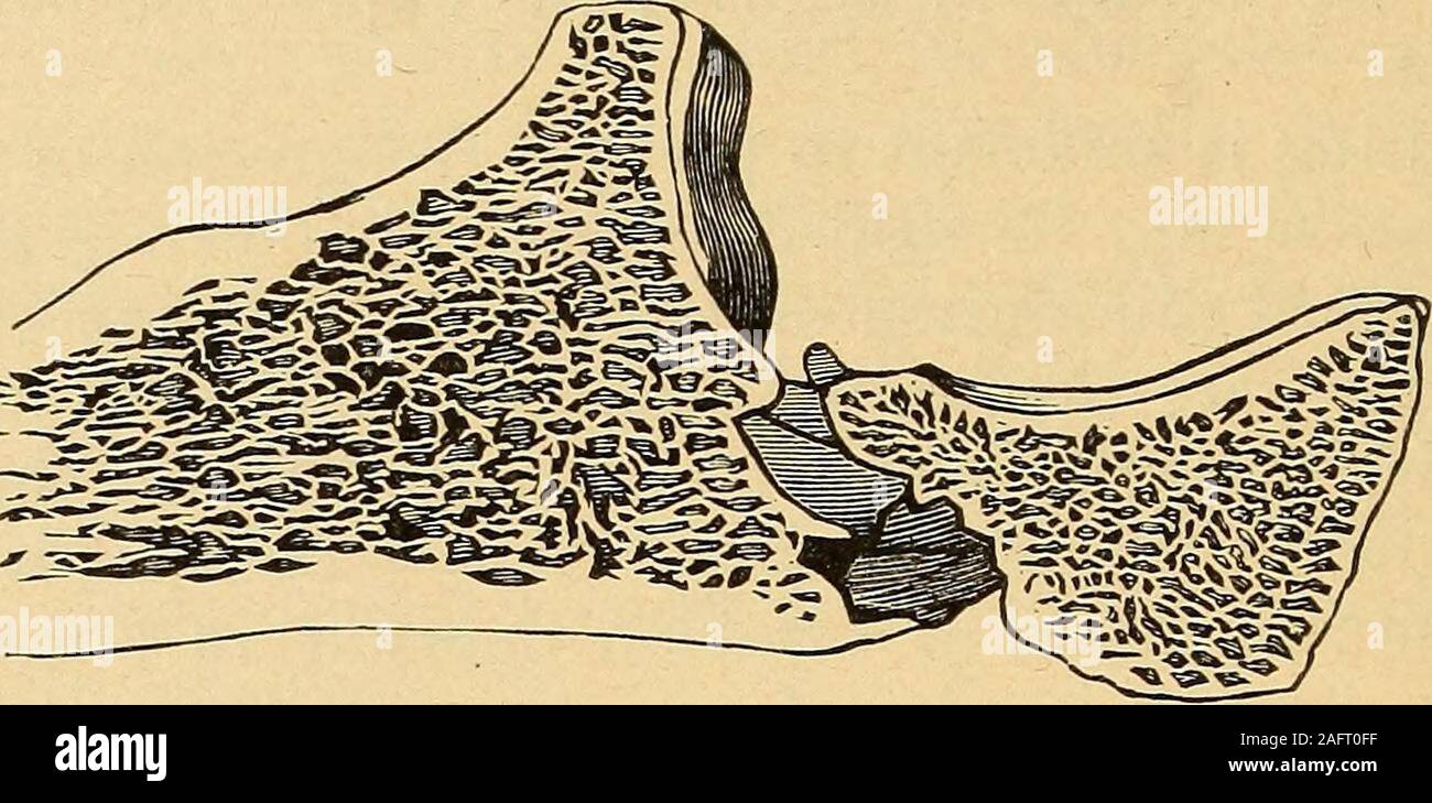 Olecranon Fracture High Resolution Stock Photography and Images - Alamy