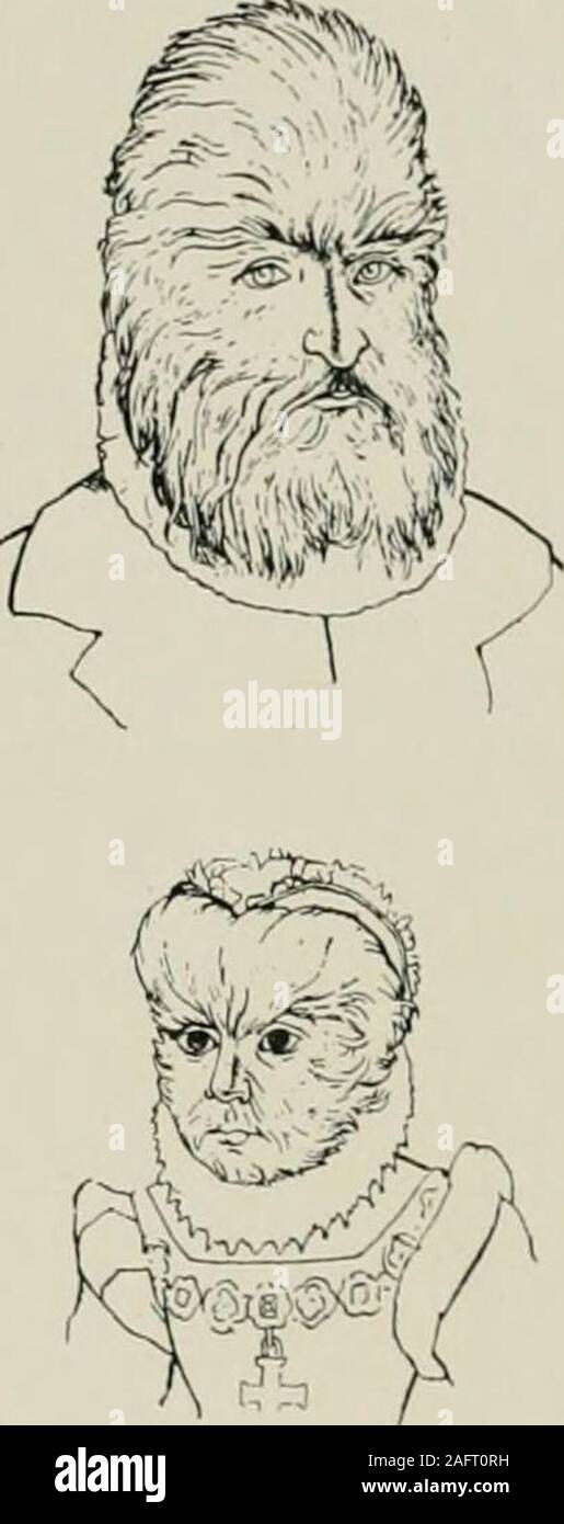 Hypertrichiasis hi-res stock photography and images - Alamy