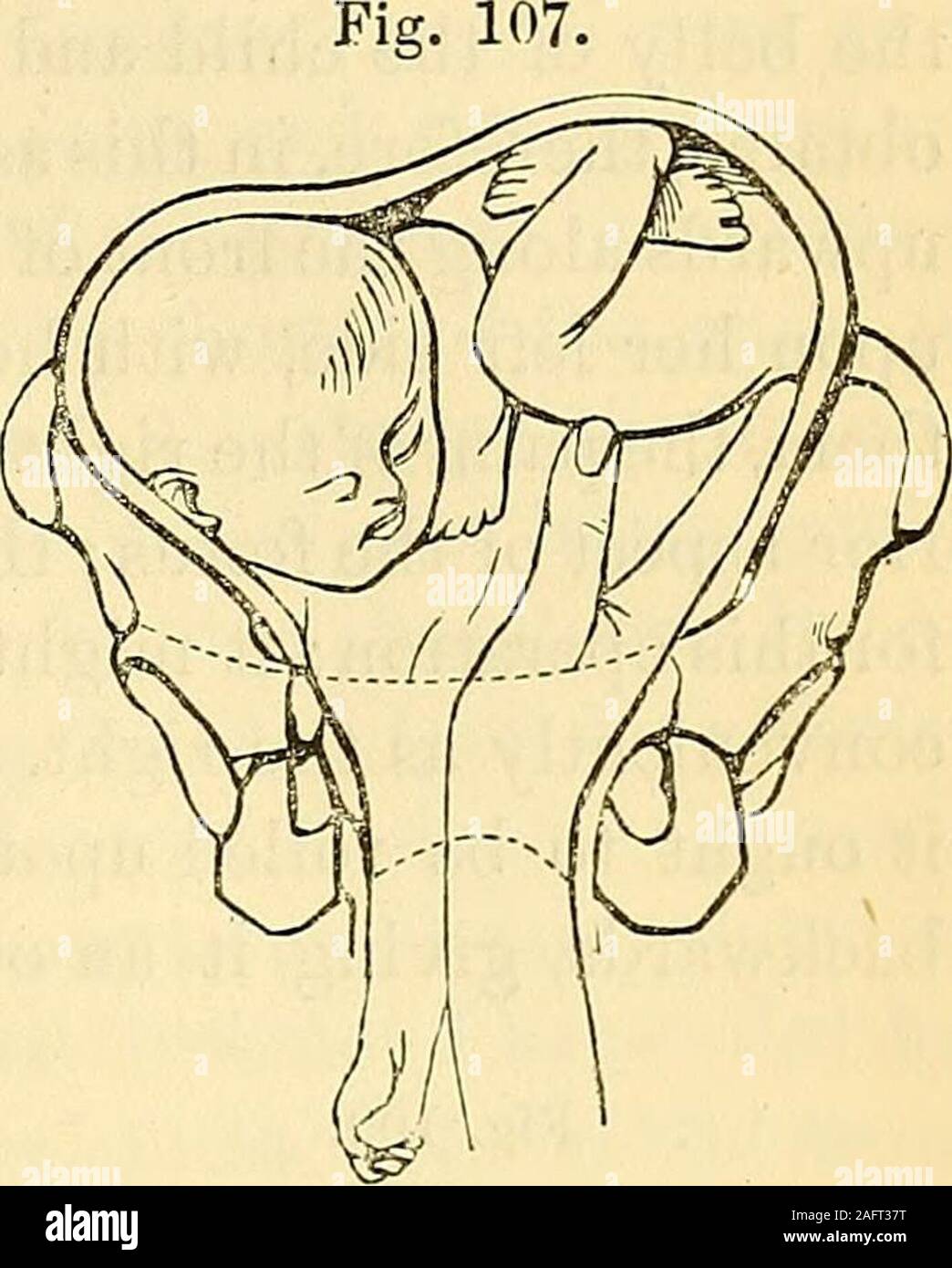 Cephalic presentation hi-res stock photography and images - Alamy