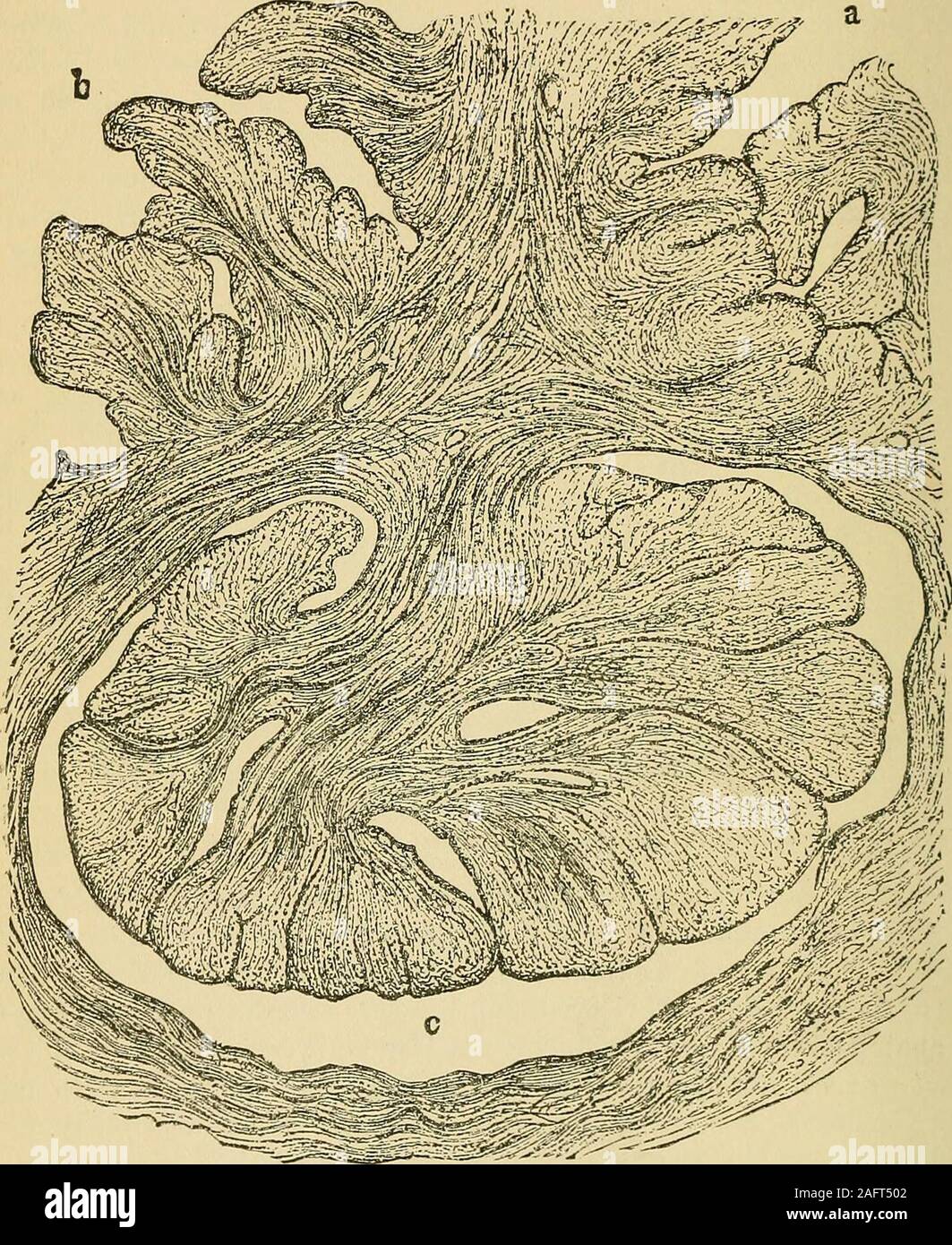 Fluid cysts hi-res stock photography and images - Alamy