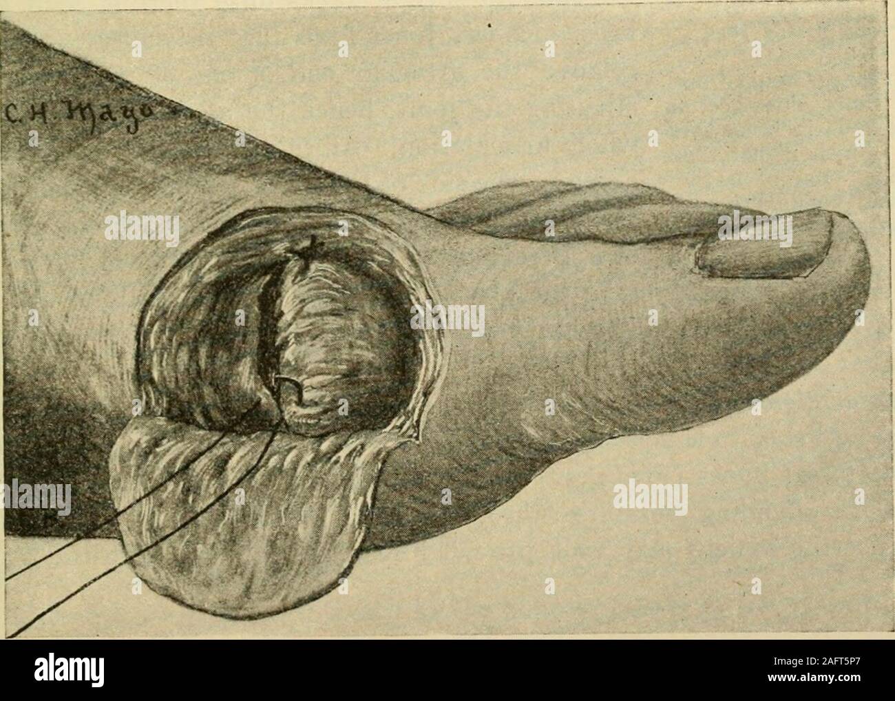 Hallux rigidus hi-res stock photography and images - Alamy