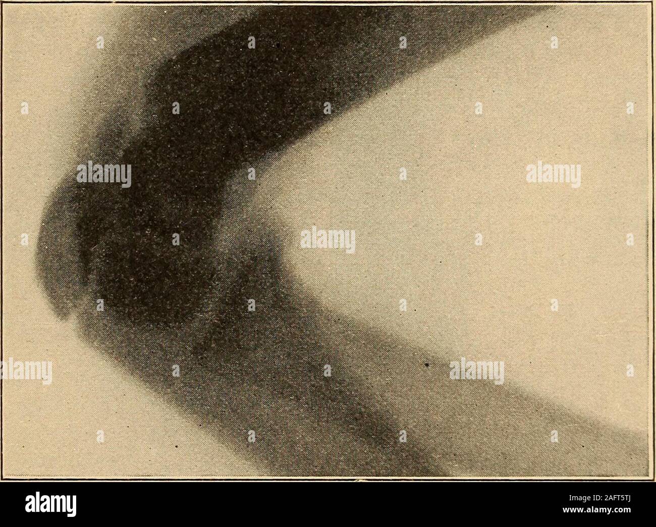 Limb reduction deformity hi-res stock photography and images - Alamy