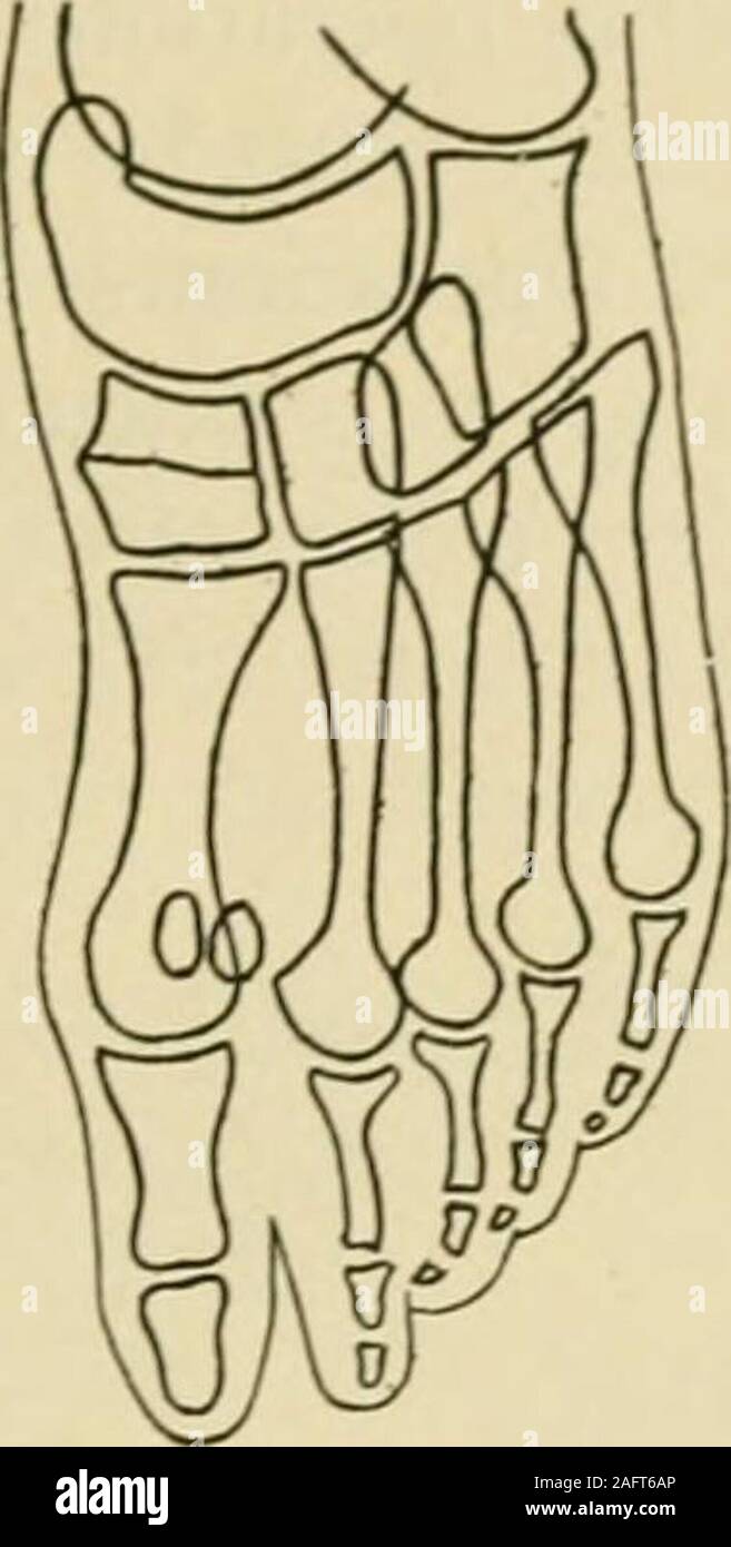 Phalangeal hi-res stock photography and images - Alamy