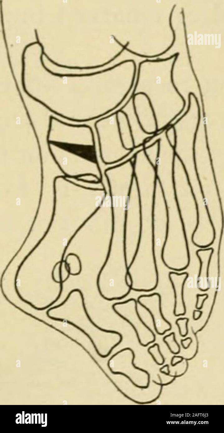 . Manual of operative surgery. 3.—Close the wound. Apply dressings ...