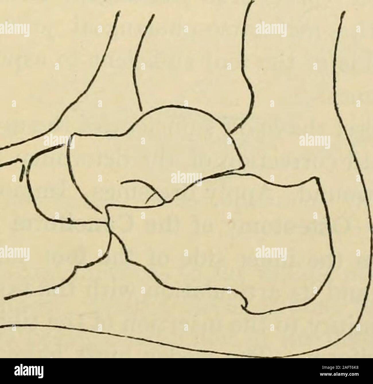 . Manual of operative surgery. Fig. 1325.—Exostosis os calcis ...