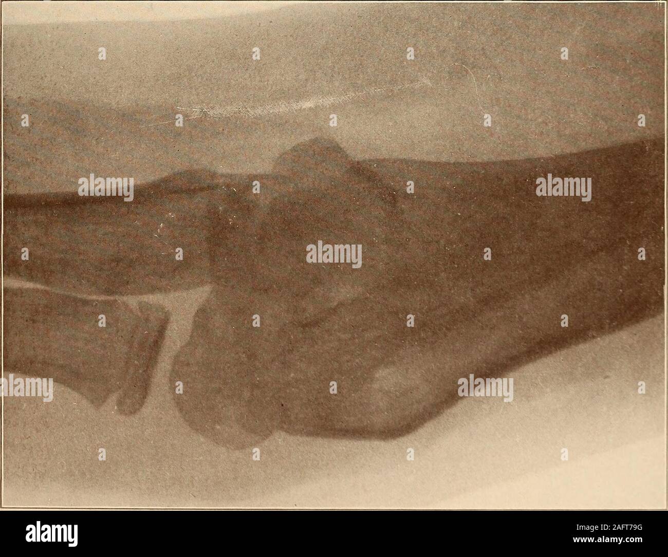 . A practical treatise on fractures and dislocations. Fig. 1.—Old ...