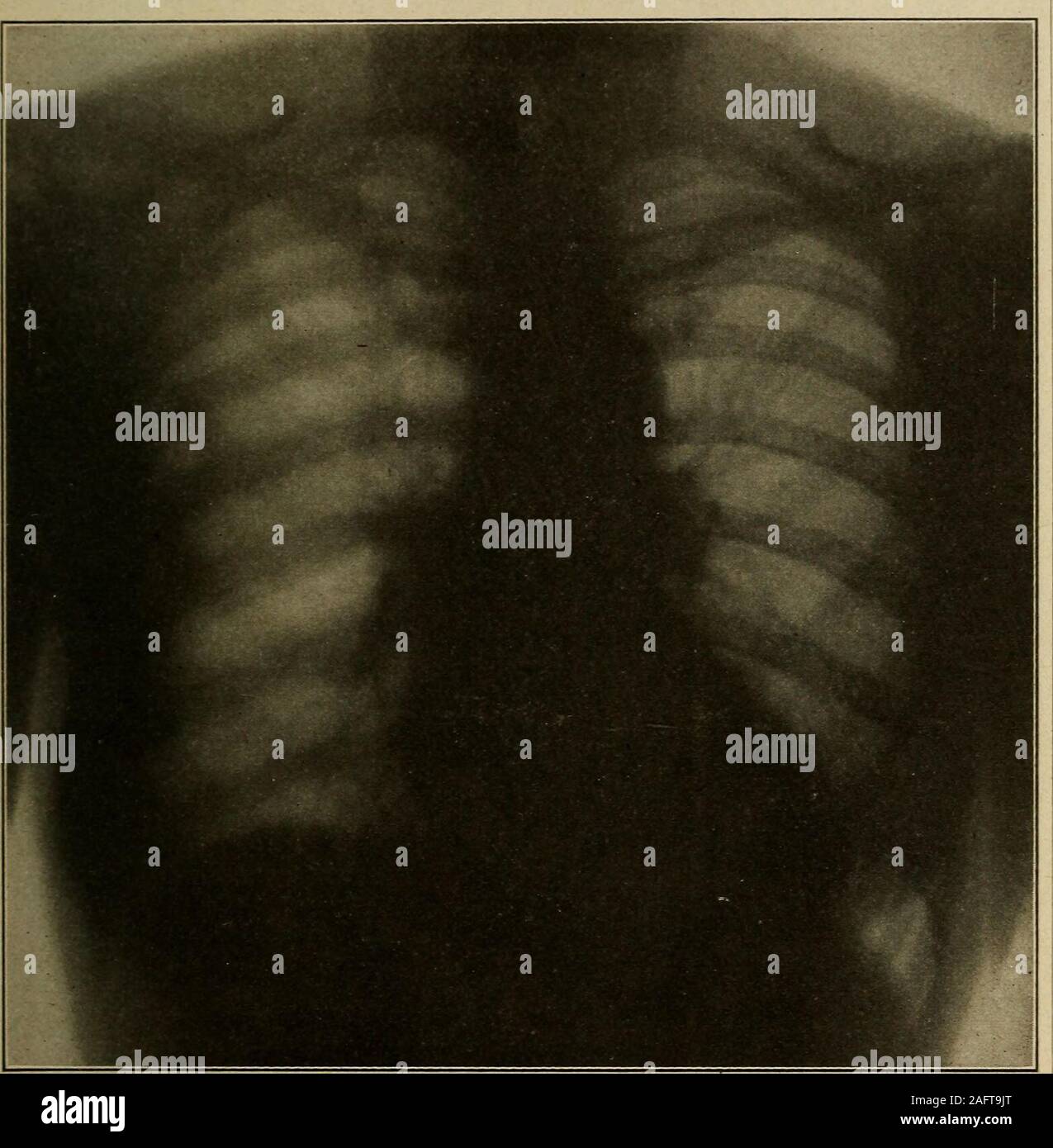 Cardiovascular syphilis hi-res stock photography and images - Alamy