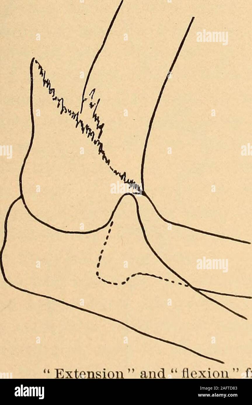 . A practical treatise on fractures and dislocations. Kochers ...