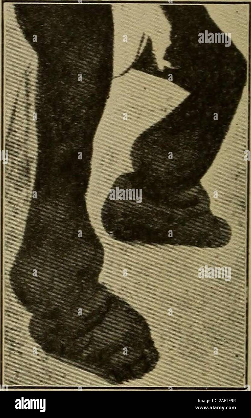 Subcutaneoustissue hi-res stock photography and images - Alamy