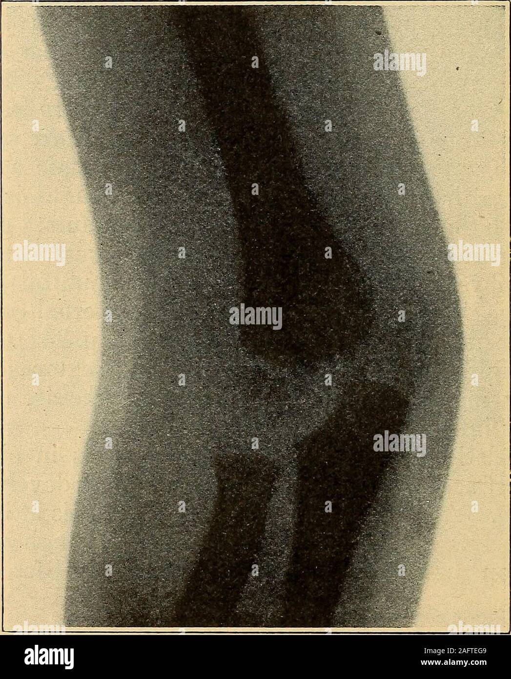 . A practical treatise on fractures and dislocations. Twelfth to ...