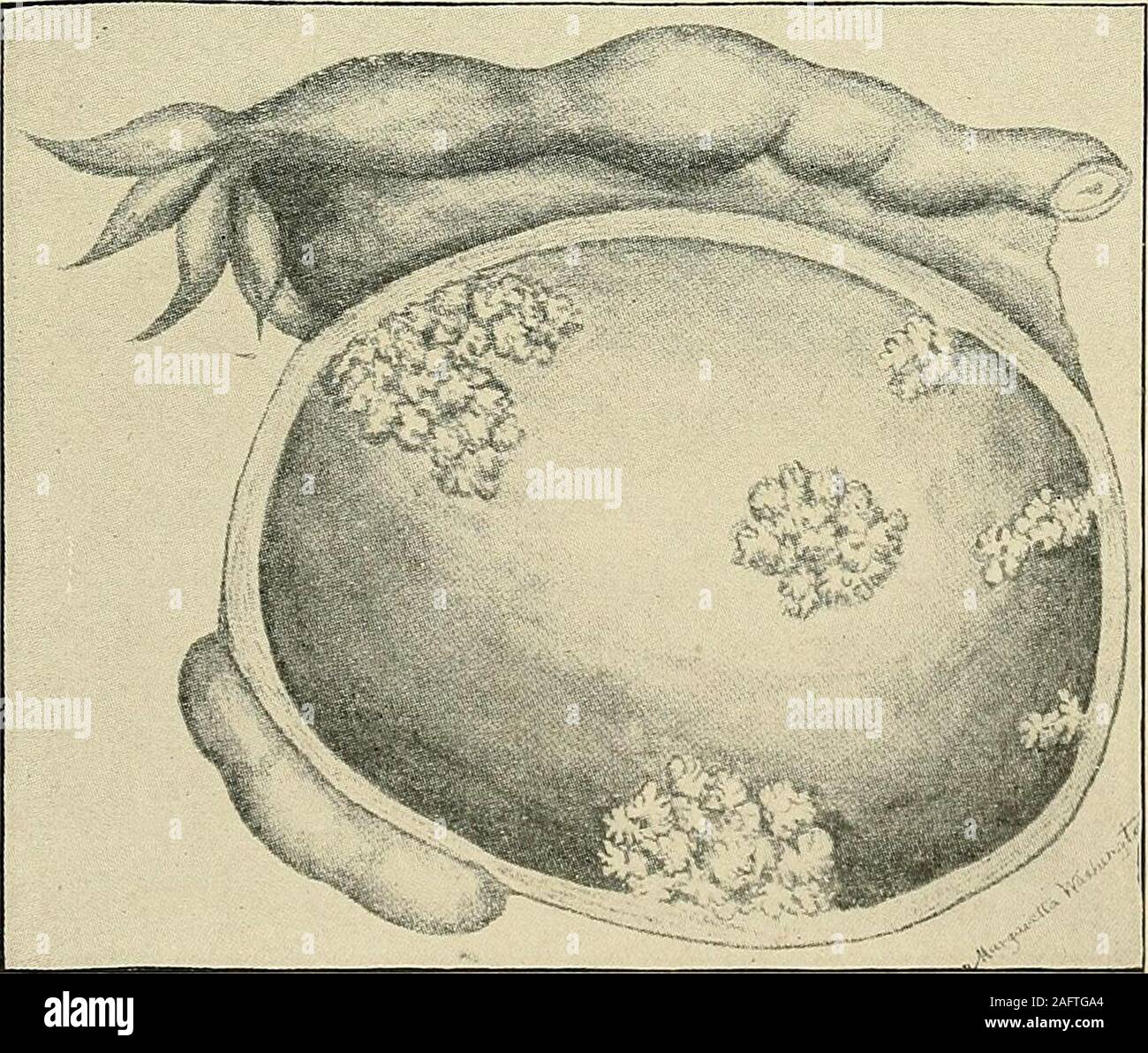 Papillary cystadenoma hi-res stock photography and images - Alamy