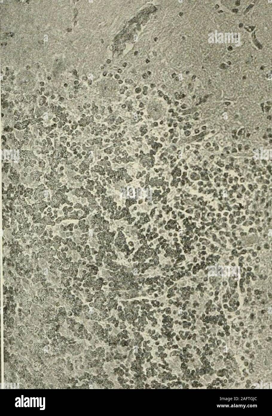 . The Journal of nervous and mental disease. infiltration of ...