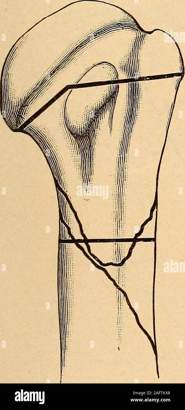 Teres major hi-res stock photography and images - Alamy