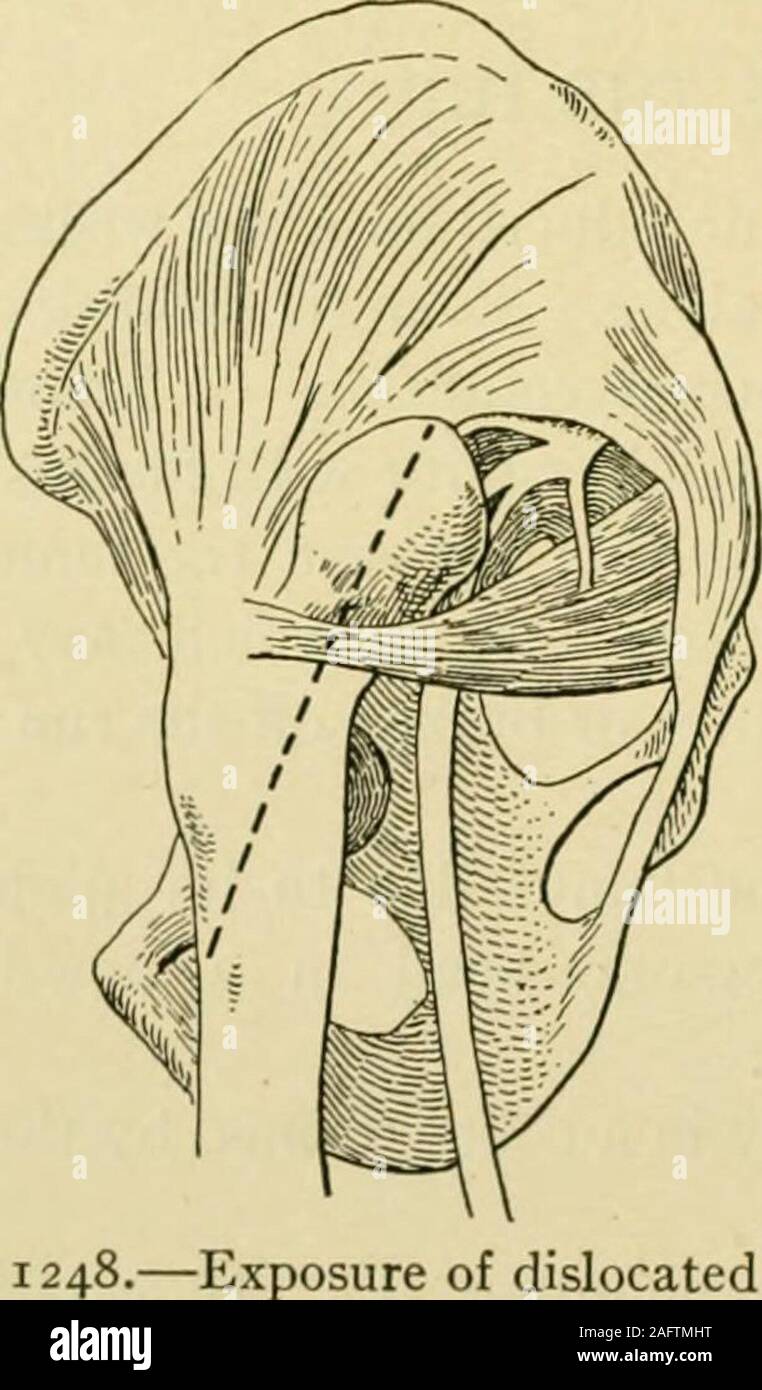 . Manual of operative surgery. he femur from its surroundings by ...