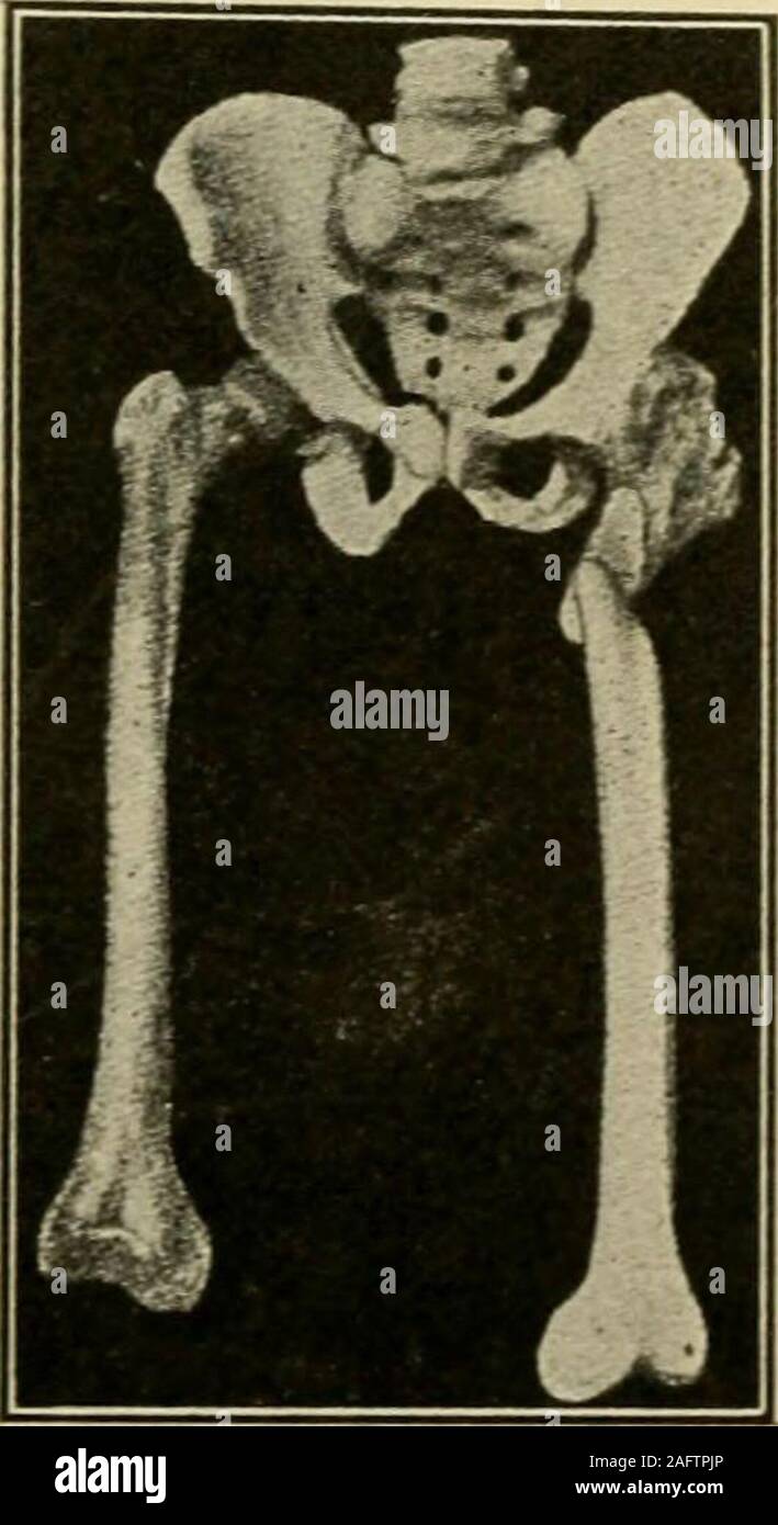Trochanteric osteotomy hi-res stock photography and images - Alamy