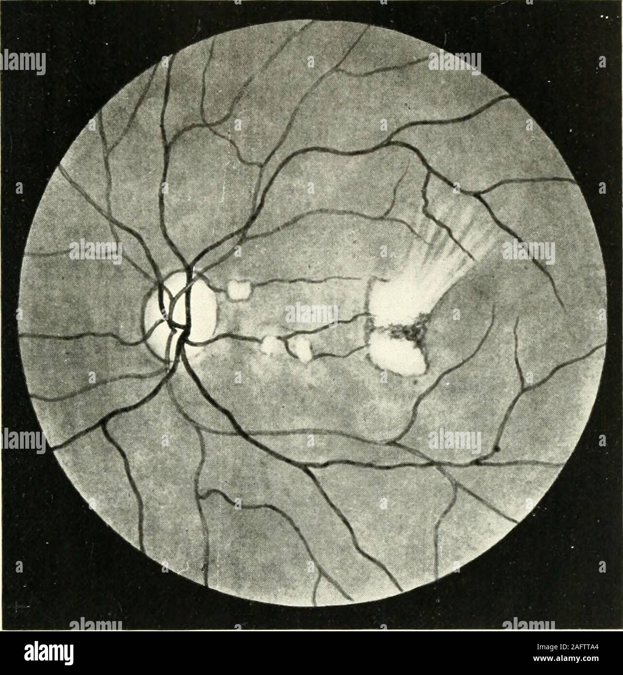 . Oftalmología; estadística [1.]-3. ser. Fig> B.^o. D. Atrofia retina y ...