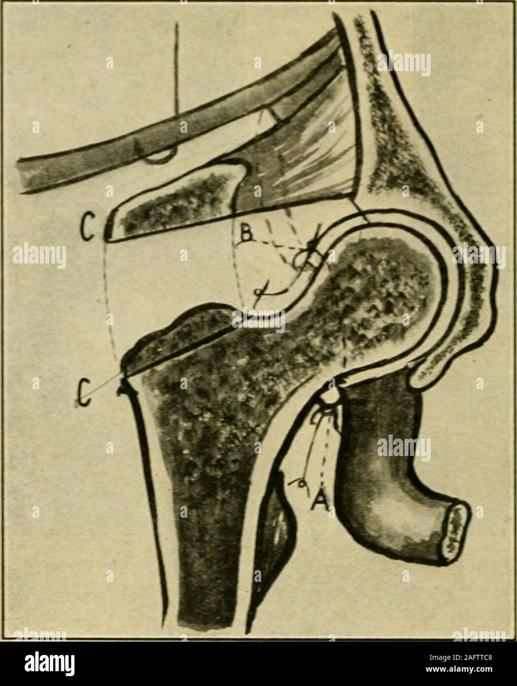 Anchylosis hi-res stock photography and images - Alamy