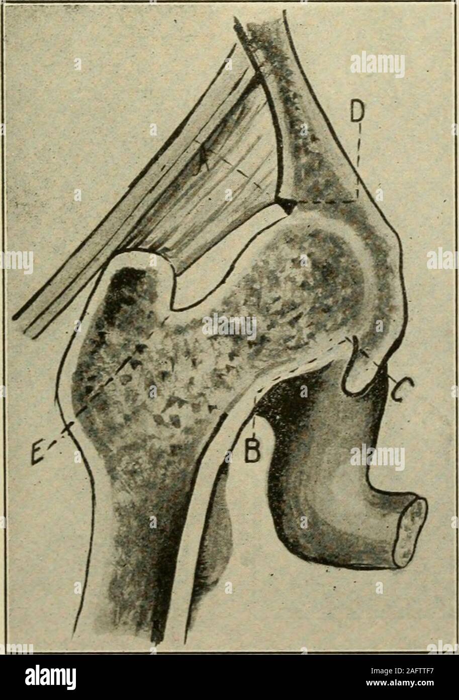 Anchylosis hi-res stock photography and images - Alamy