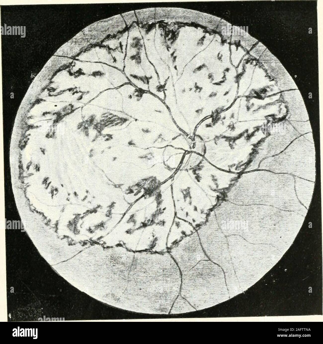 La coroides y la retina hi-res stock photography and images - Alamy