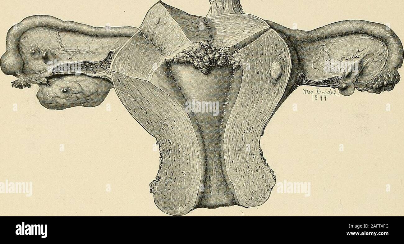 Cauterization hi-res stock photography and images - Alamy