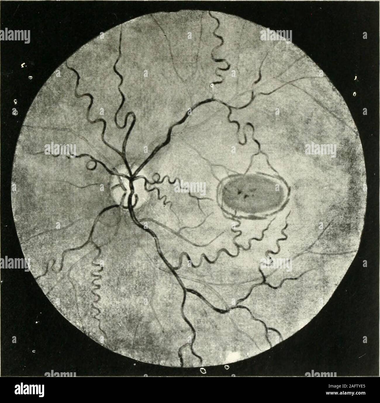 La coroides y la retina hi-res stock photography and images - Alamy