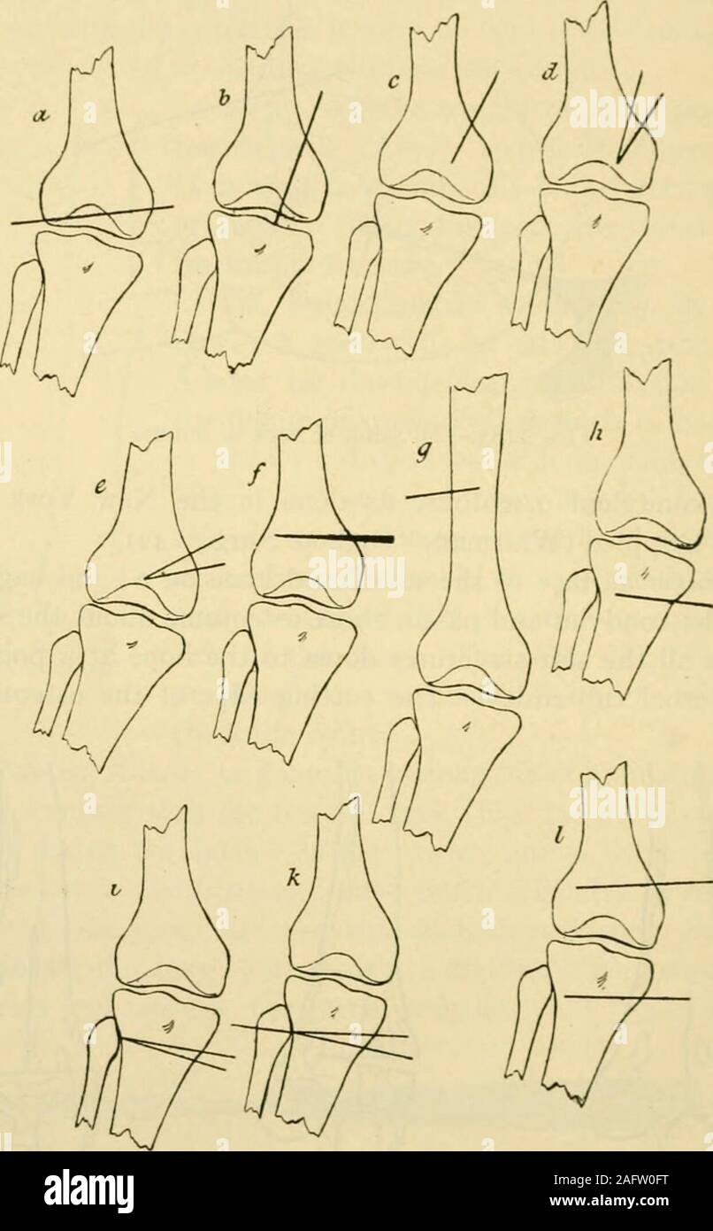 Osteotome hi-res stock photography and images - Alamy