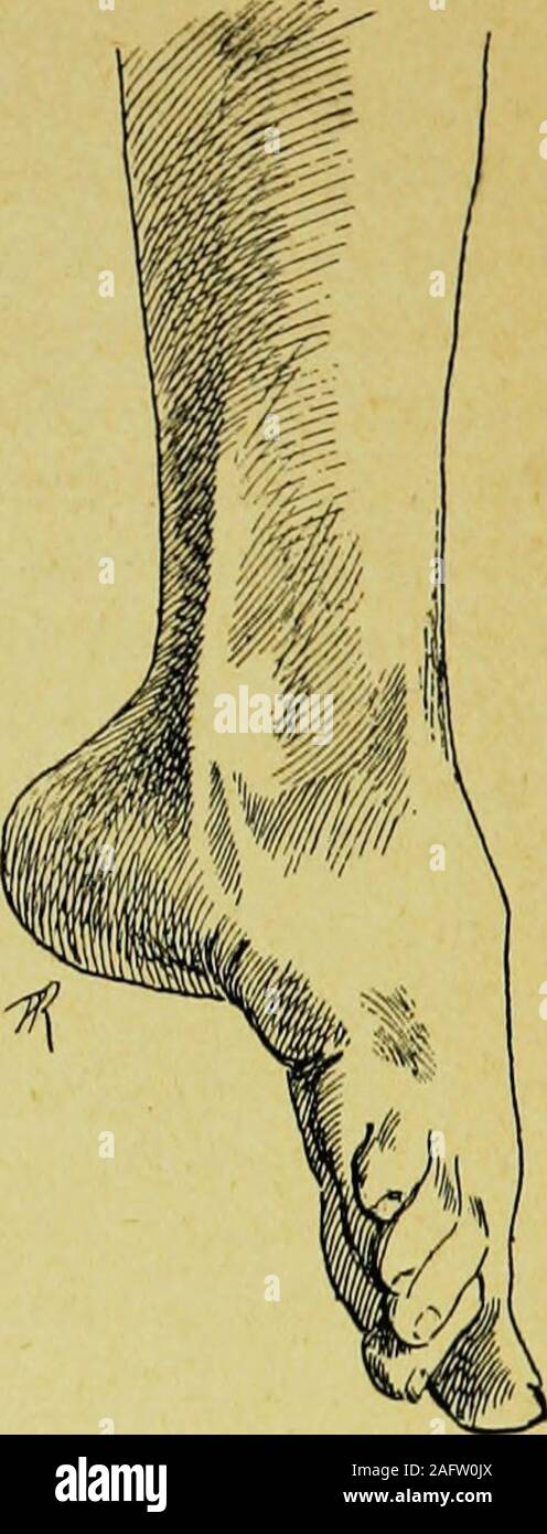 Flexion contracture hi-res stock photography and images - Alamy