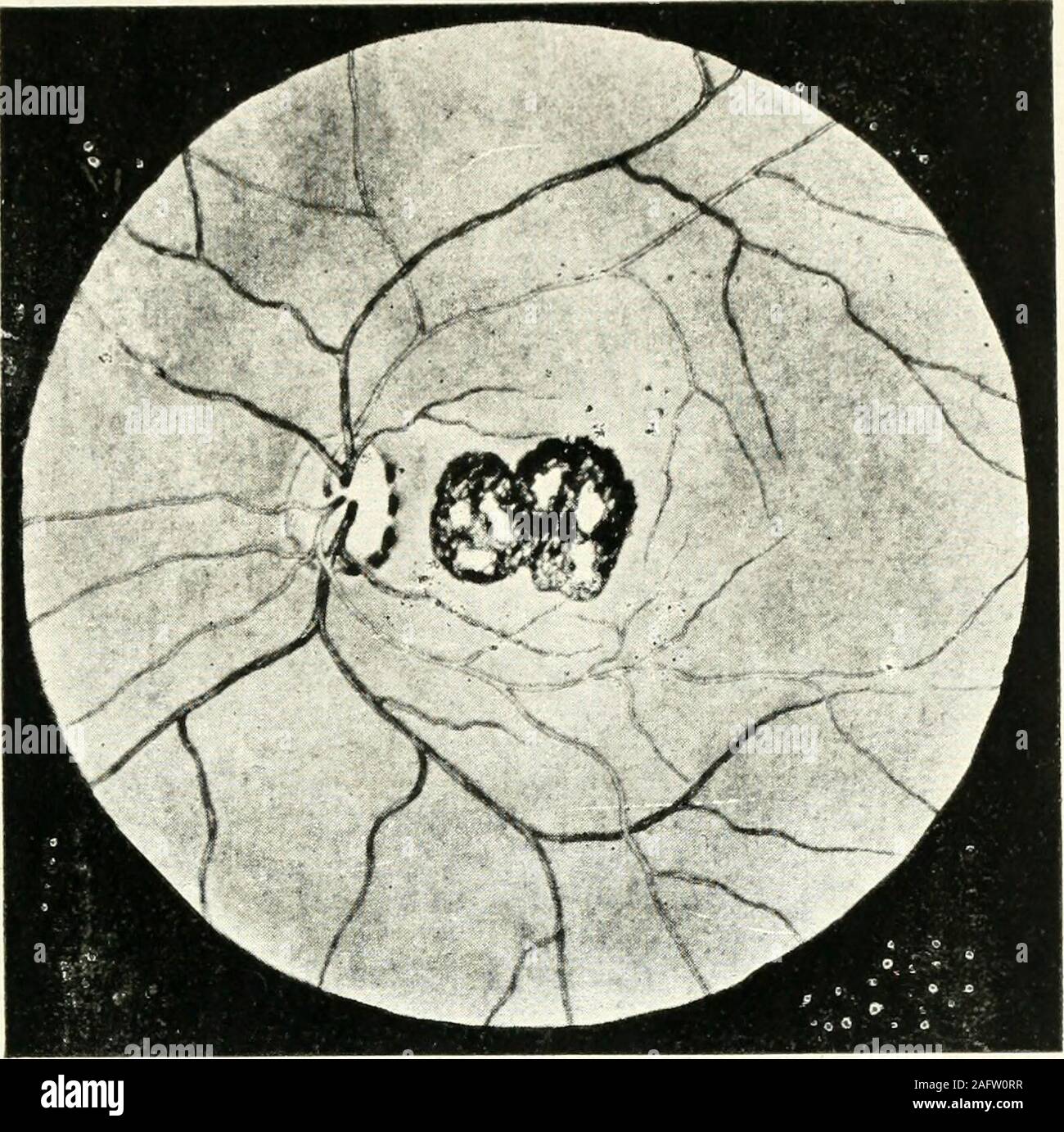 . Oftalmología; estadística [1.]-3. ser. ;? .? i, o. I. Coroiditis ...