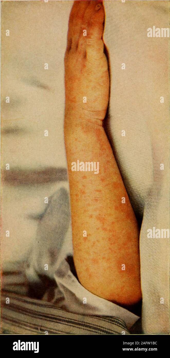 Skin mottling hi-res stock photography and images - Alamy